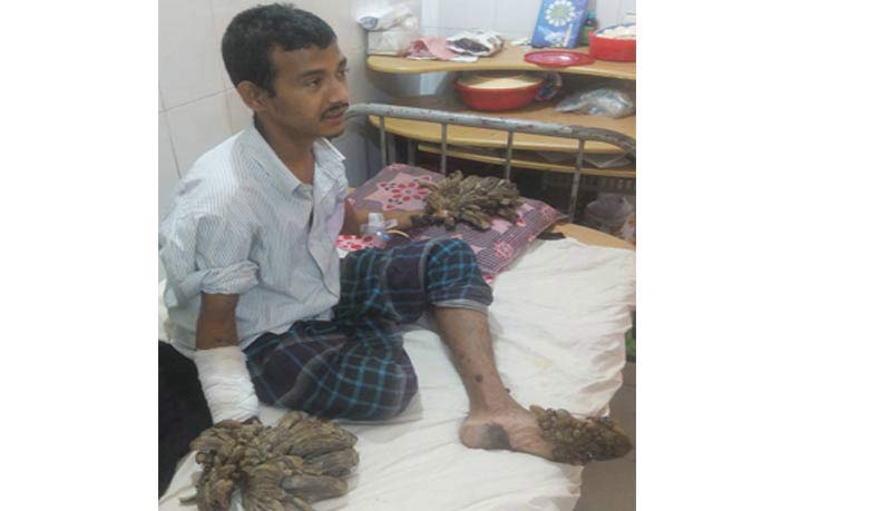 `Tree man` Abul undergoing surgery today